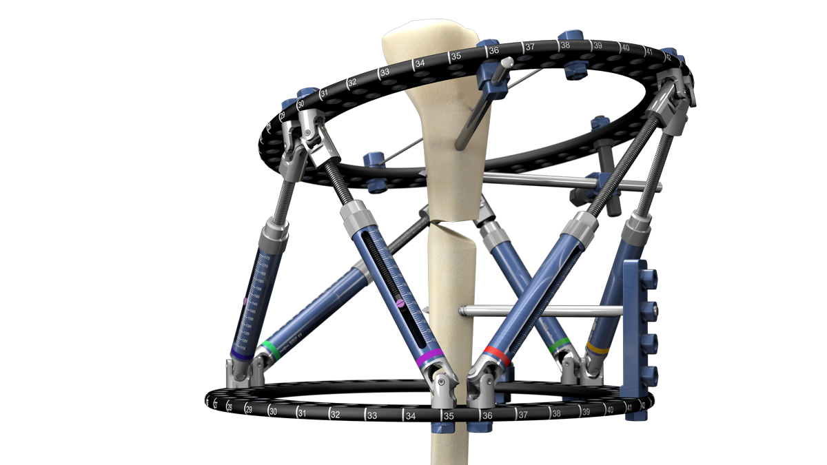 Smart Fixator - Circular Hexapod External Fixator