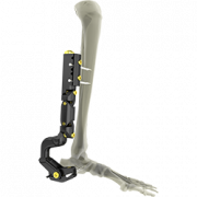 EXTERNAL FIXATORS - Response Ortho