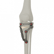 EXTERNAL FIXATORS - Response Ortho
